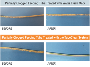 Prophylactic use of the TubeClear system reduces feeding tube material ...